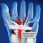 Hand and Wrist Doctors & Treatment at The Hand Center | OrthoConnecticut