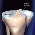Knee Fracture | OrthoConnecticut